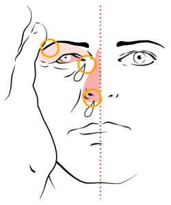 Algie vasculaire de la face (AVF) - AJR Médical - Marseille